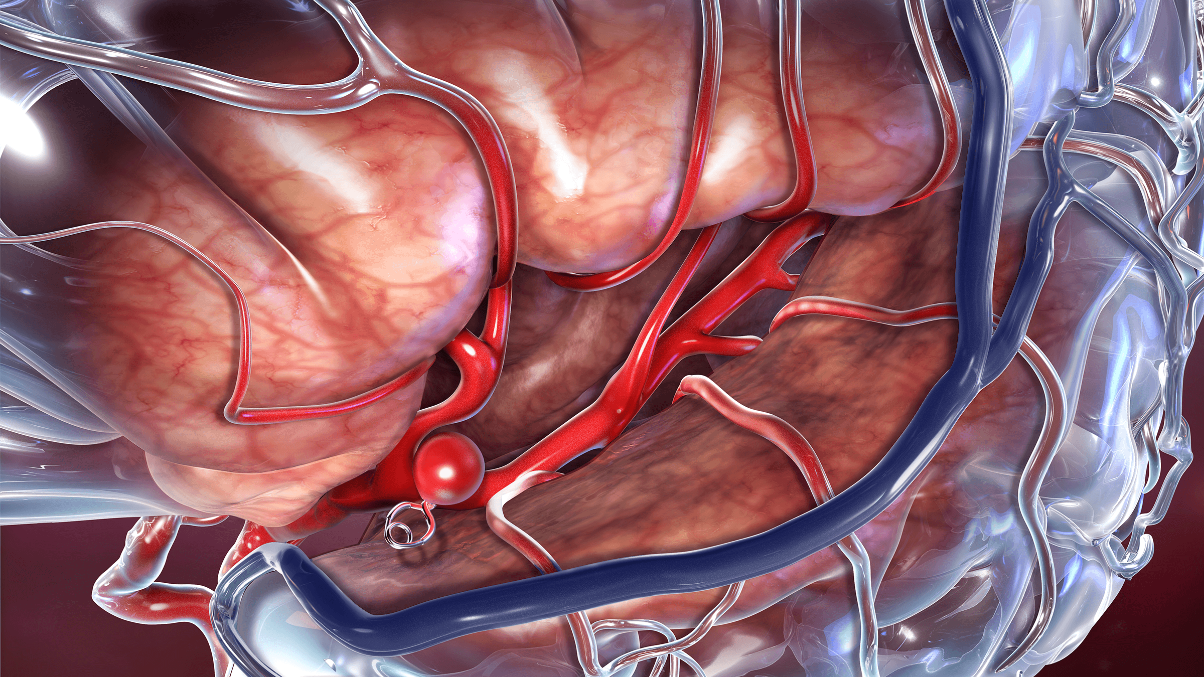 Brain Aneurysm Barrow Neurological Institute