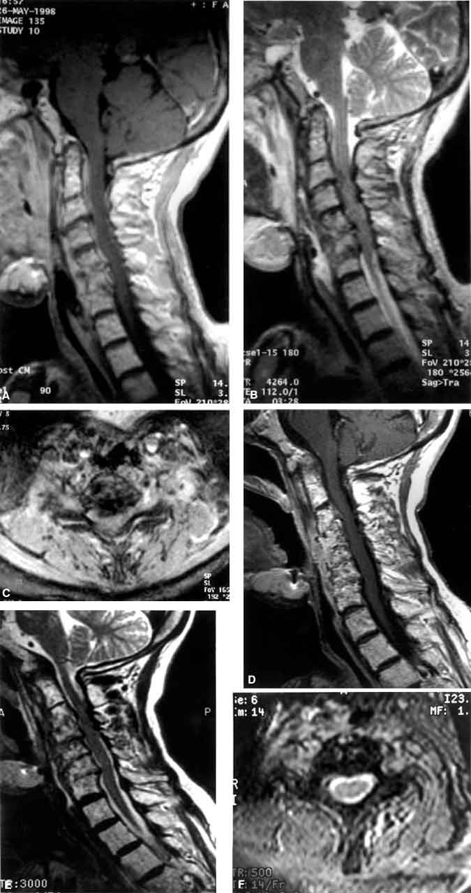 Clinical Images Nonsurgical Treatment Of A Cervical Epidural Abscess
