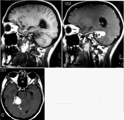 Hemangioblastoma with a "Dural Tail" Sign: Case Report - Barrow ...