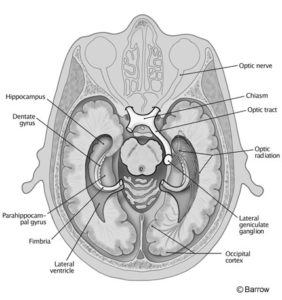 Meyer’s Loop - Barrow Neurological Institute