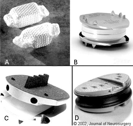 Spinal Disk Arthroplasty - Barrow Neurological Institute