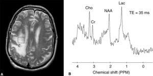 Current Clinical Applications of MR Spectroscopy of the Brain - Barrow ...