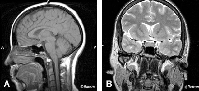 Imaging of the Pituitary Gland | Barrow