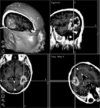 Cranial Application of Frameless Stereotaxy - Barrow Neurological Institute