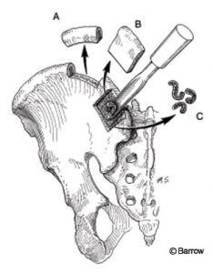 Bone Graft Harvest - Barrow Neurological Institute