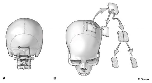 Bone Graft Harvest - Barrow Neurological Institute