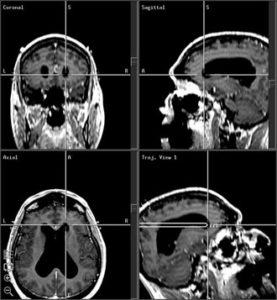 Cranial Application of Frameless Stereotaxy - Barrow Neurological Institute