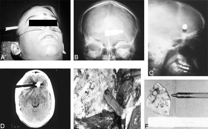 Clinical Images: A Self-Inflicted Crossbow Wound