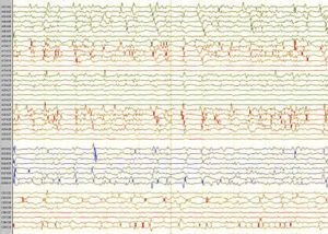 Resolution of Status Epilepticus After Subdural Grid Recording and ...