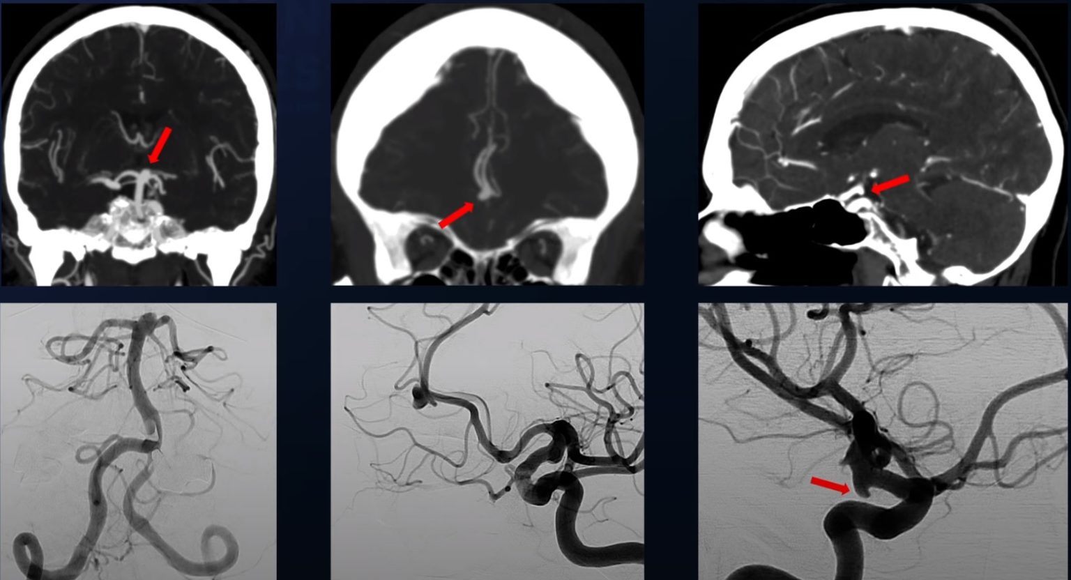 Brain Aneurysm | Barrow Neurological Institute