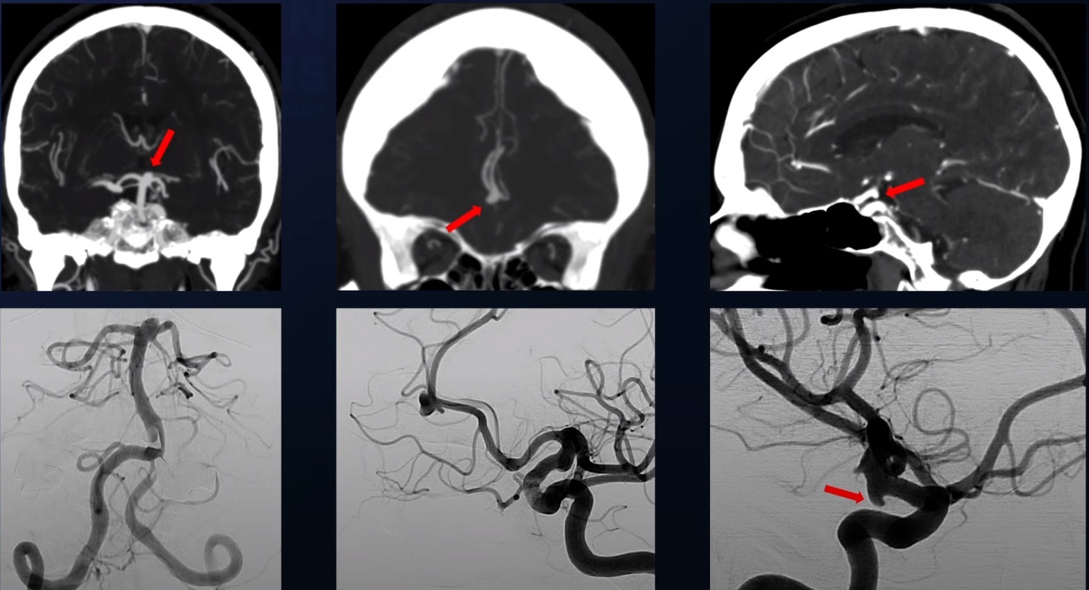 Brain Aneurysm Barrow Neurological Institute