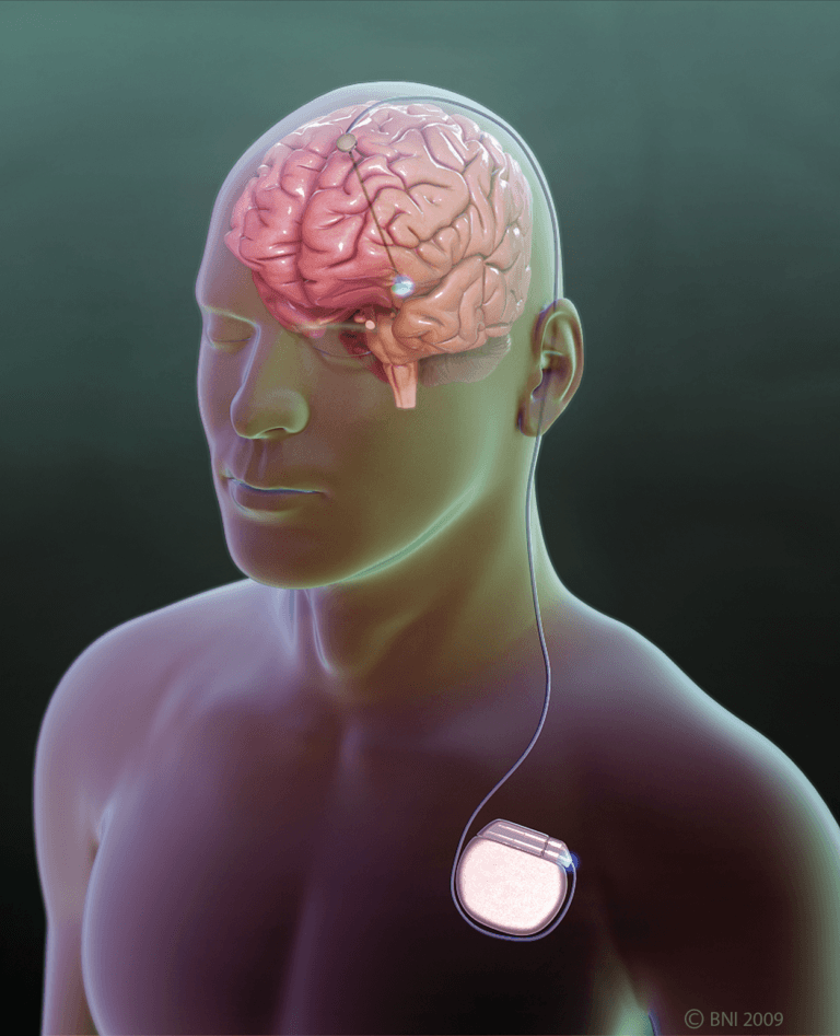 Deep Brain Stimulation Surgery (DBS)