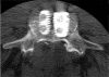 Internal Fixation and Fusion of the Lumbar Spine Using Threaded ...