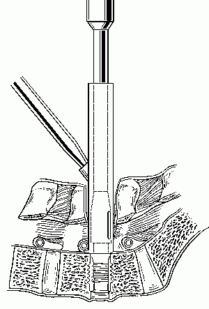 Internal Fixation and Fusion of the Lumbar Spine Using Threaded ...