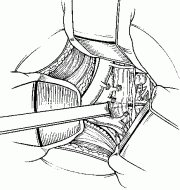 Internal Fixation and Fusion of the Lumbar Spine Using Threaded ...