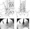 Internal Fixation and Fusion of the Lumbar Spine Using Threaded ...