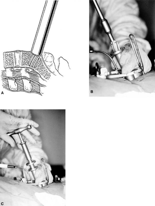 Internal Fixation and Fusion of the Lumbar Spine Using Threaded ...