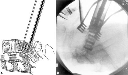 Internal Fixation and Fusion of the Lumbar Spine Using Threaded ...