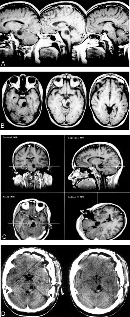 The Two-Point Method: Evaluating Brain Stem Lesions - Barrow ...