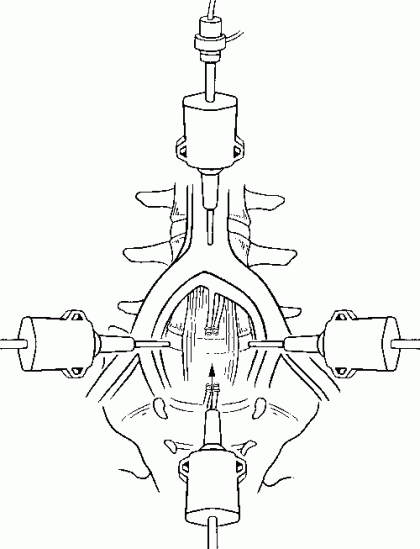 The Laparoscopic Approach for Instrumentation and Fusion of the Lumbar ...