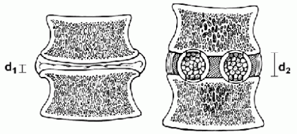 Internal Fixation and Fusion of the Lumbar Spine Using Threaded ...