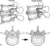 Internal Fixation and Fusion of the Lumbar Spine Using Threaded ...