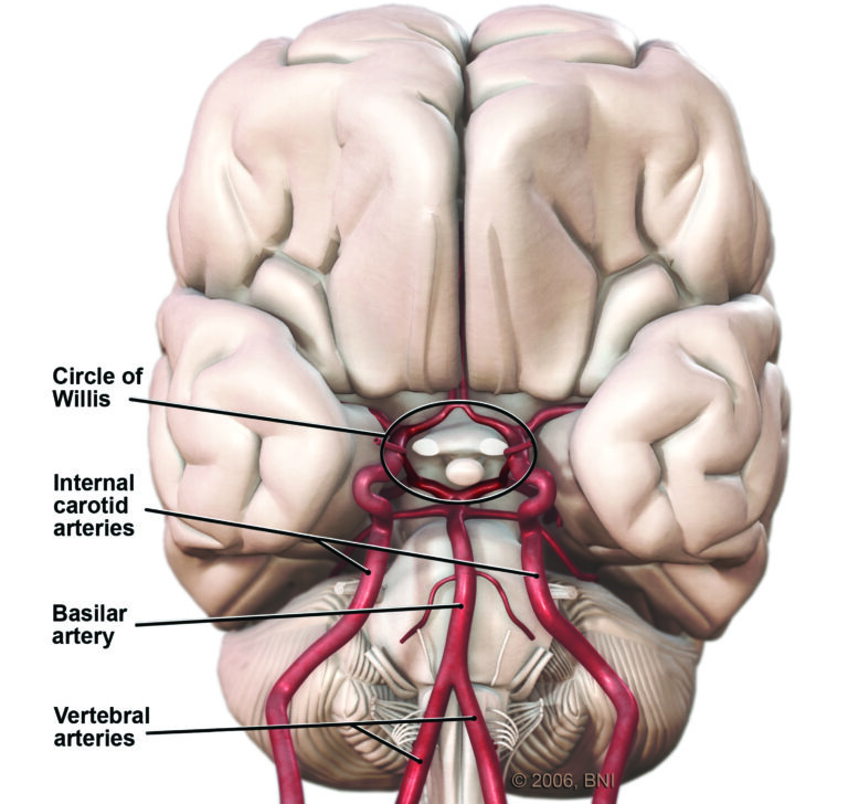 Brain Arteriovenous Malformation (AVM) - Diagnosis and Treatment