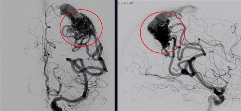 Brain Arteriovenous Malformation (AVM) - Diagnosis and Treatment