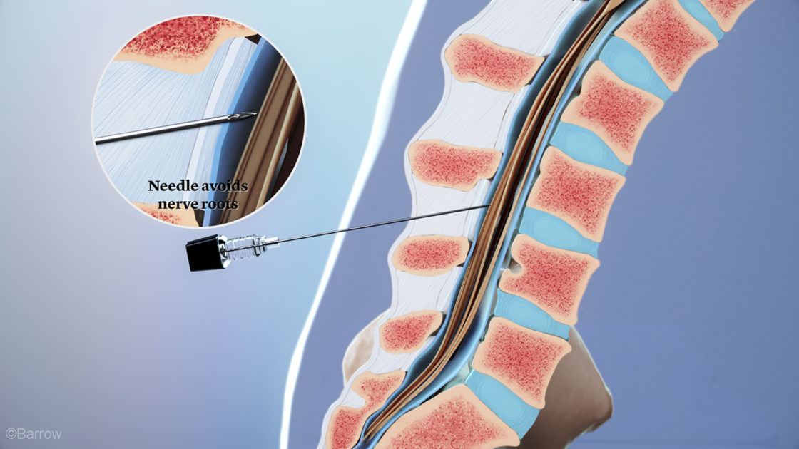 What are Spinal Injections? | Barrow Neurological Institute