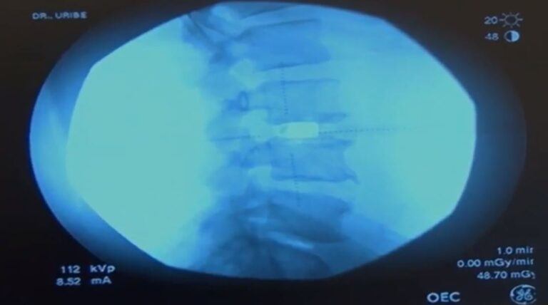 Extreme Lateral Interbody Fusion (XLIF)