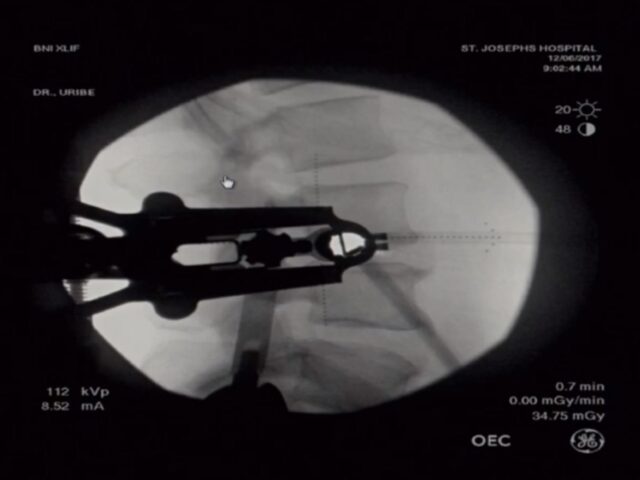 Extreme Lateral Interbody Fusion (XLIF)