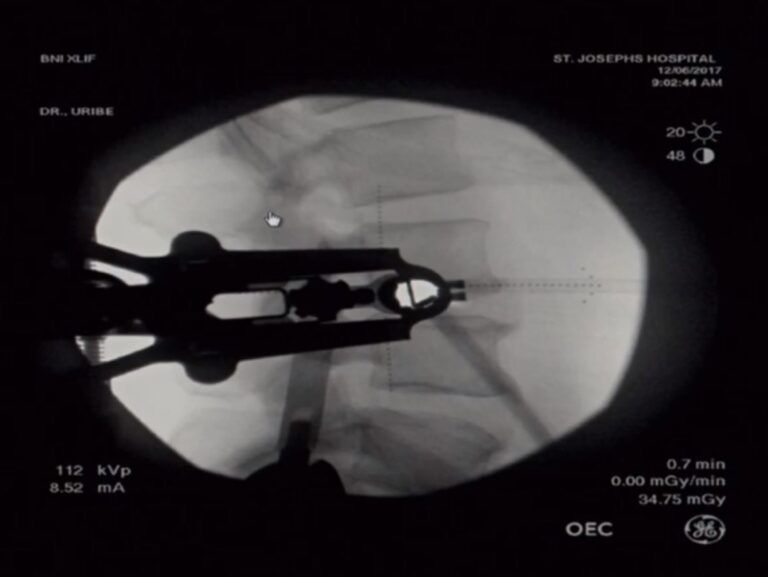 Extreme Lateral Interbody Fusion (XLIF)